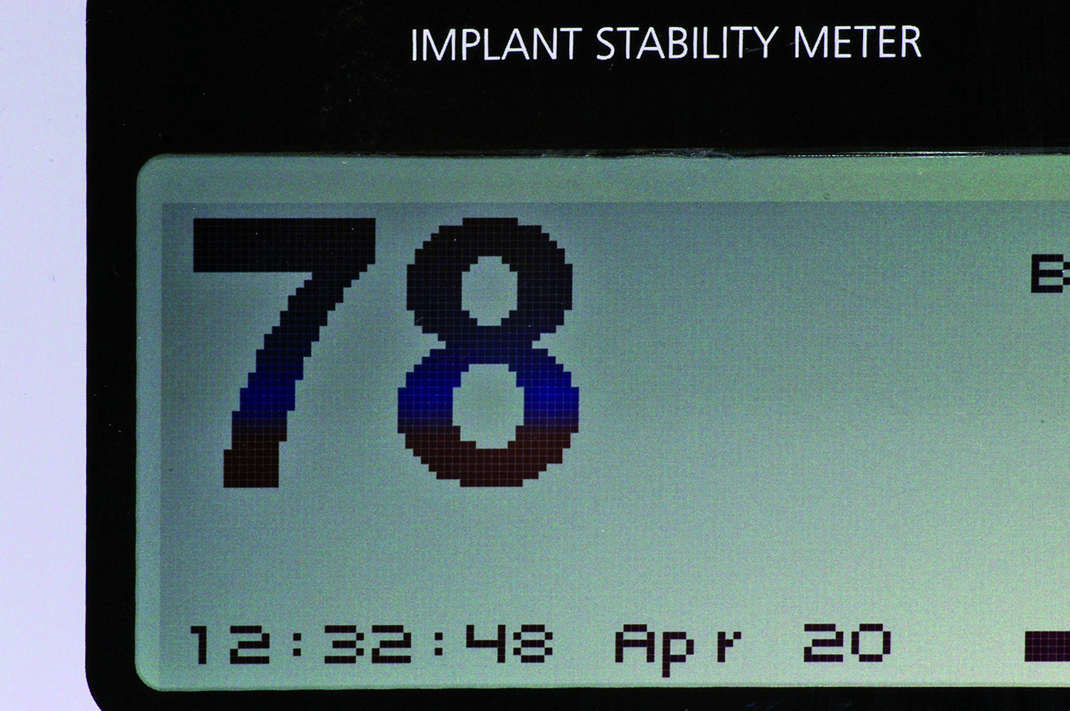 Using CAD/CAM for a combination approach to full mouth reconstruction